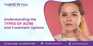 Types of Acne and How to Treat Them - TheNewYou
